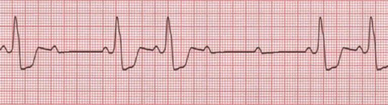 Understanding Atrioventricular Blocks - ACLS.com