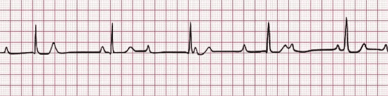 Understanding Atrioventricular Blocks - ACLS.com
