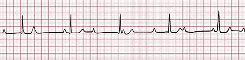 Understanding Atrioventricular Blocks - ACLS.com