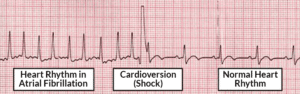 Becoming Familiar with Synchronized Cardioversion - ACLS.com
