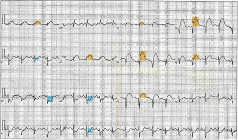 ECG Interpretation in Myocardial Ischemia | ACLS.com