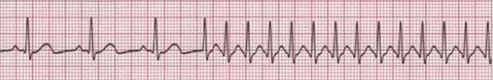 Shockable Rhythms: Ventricular Tachycardia | ACLS.com