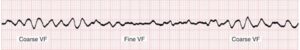Shockable Rhythms: Ventricular Tachycardia | ACLS.com