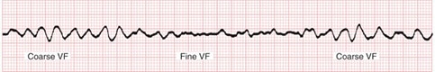 Shockable Rhythms: Ventricular Tachycardia | ACLS.com