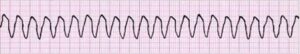 Shockable Rhythms: Ventricular Tachycardia | ACLS.com