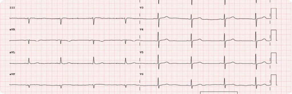 Bradycardia with a Pulse Algorithm - ACLS.com
